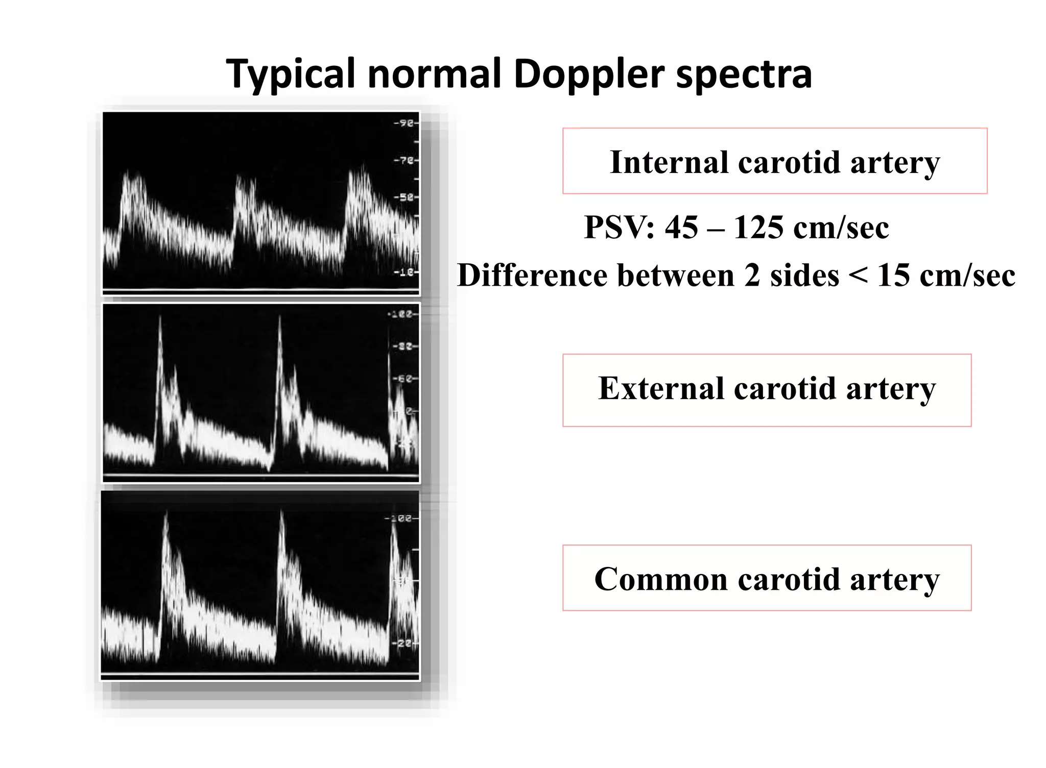 Carotid Doppler | PPT