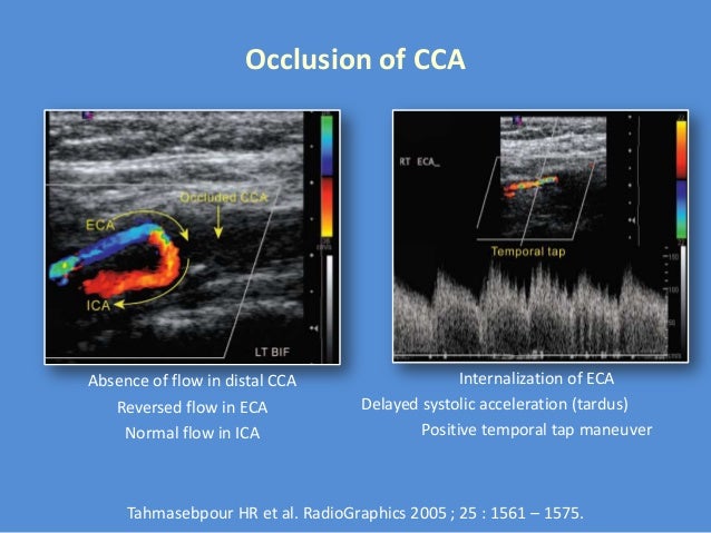 Carotid doppler ii