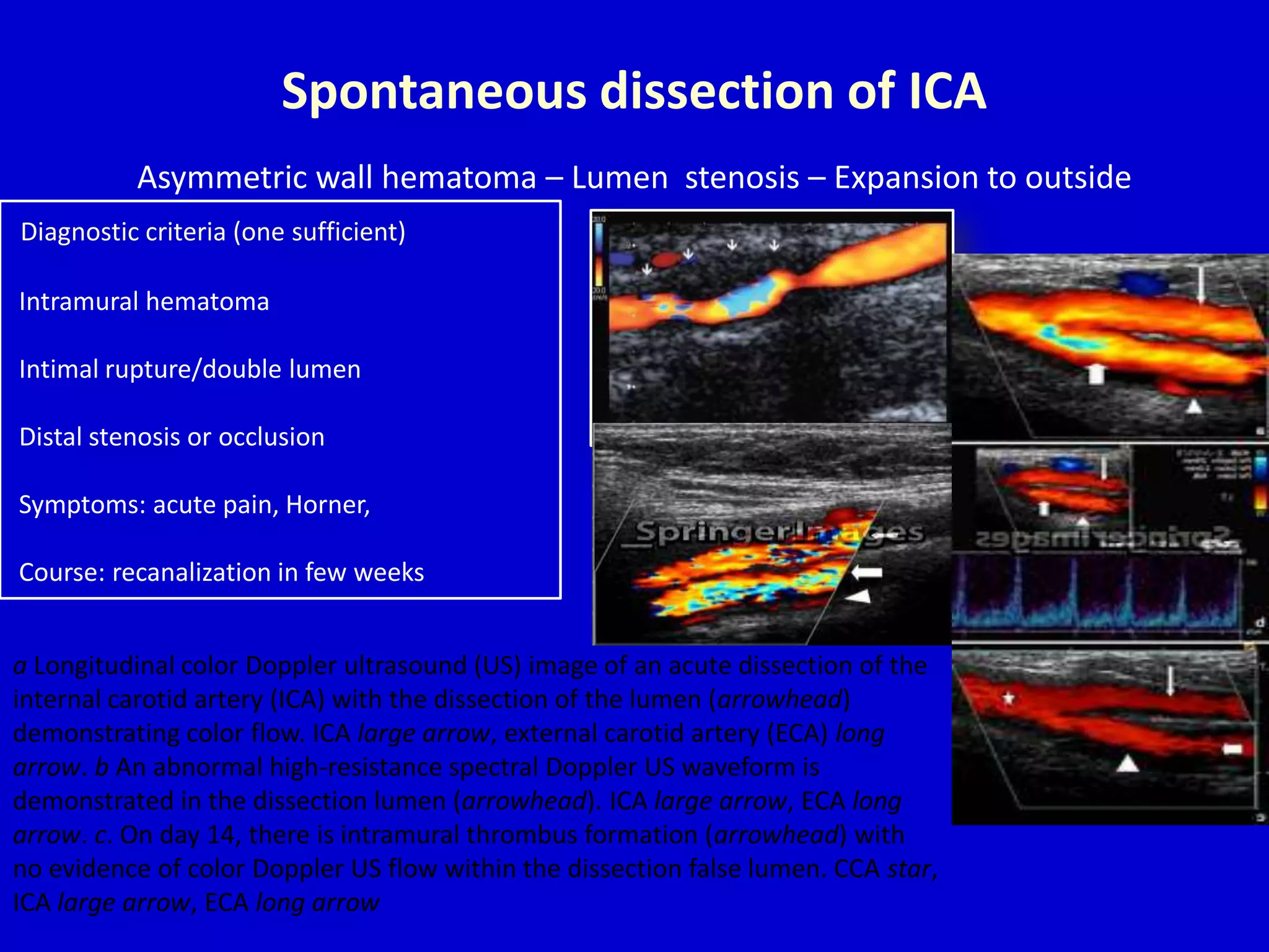Carotid doppler II Dr. Muhammad Bin Zulfiqar | PPTX