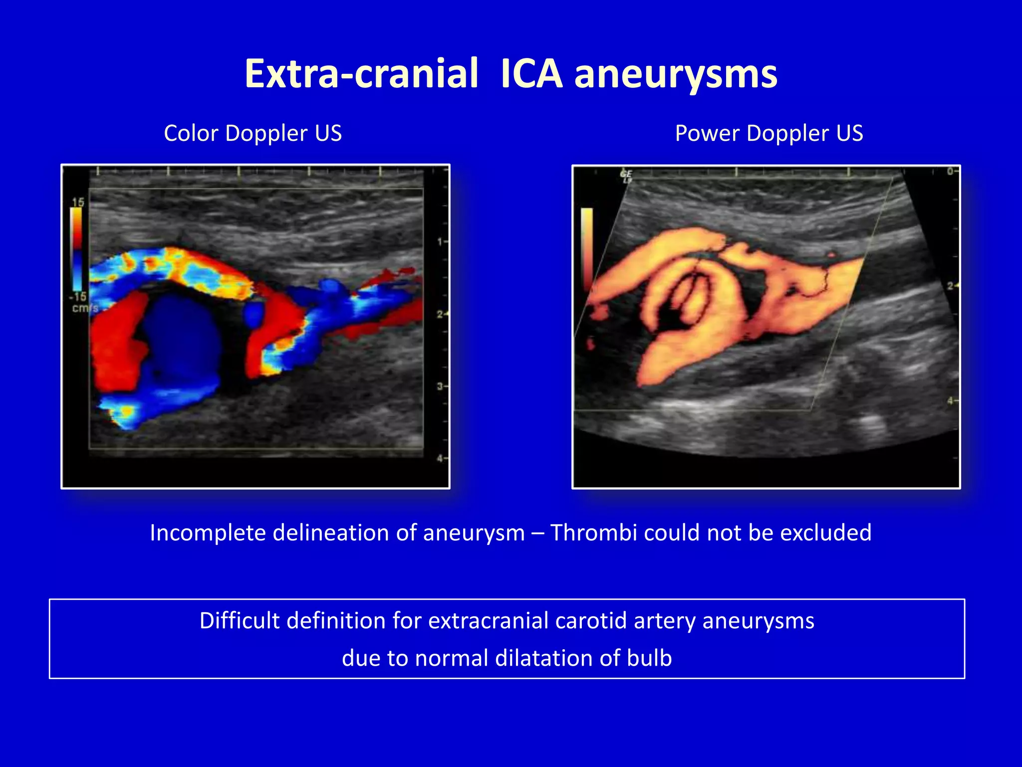 Carotid doppler II Dr. Muhammad Bin Zulfiqar | PPTX