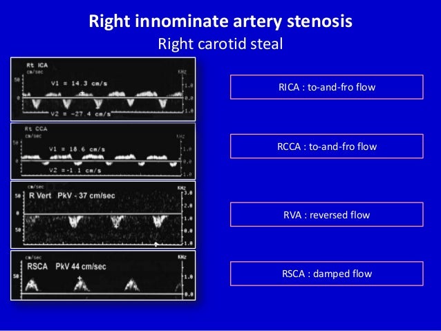 Carotid doppler II