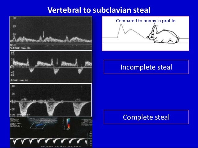 Carotid doppler II Dr. Muhammad Bin Zulfiqar