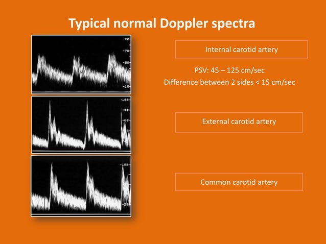 Carotid doppler ultrasound | PPTX | Heart and Cardiovascular Diseases ...