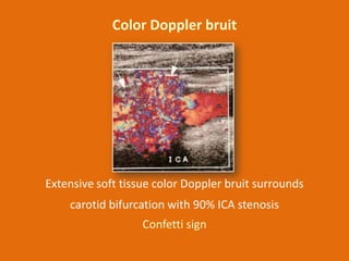 Carotid doppler ultrasound | PPTX