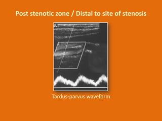 Carotid doppler ultrasound | PPTX
