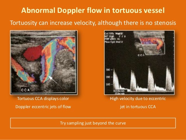 Carotid doppler ultrasound