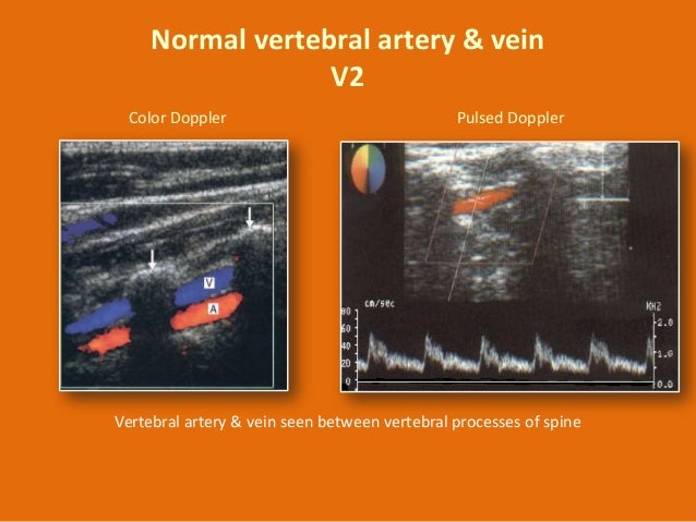 Carotid doppler ultrasound