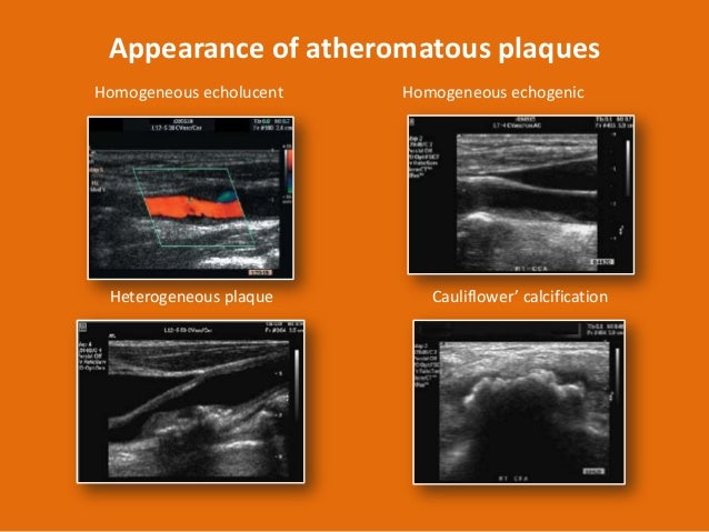 Carotid doppler ultrasound