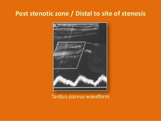 Carotid doppler ultrasound
