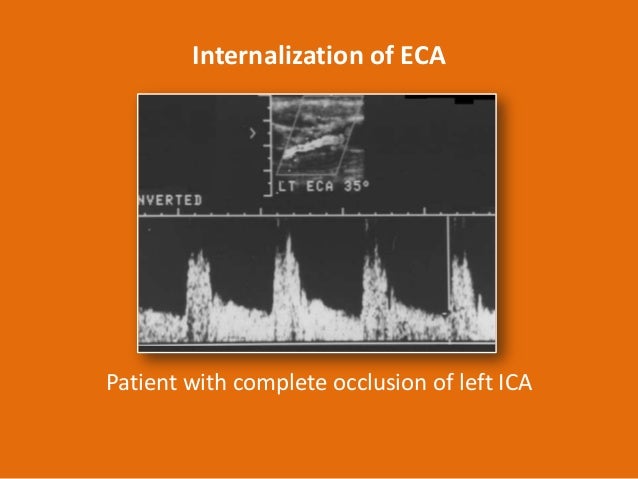 Carotid doppler ultrasound