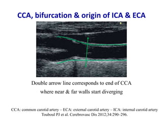 Carotid intima-media thickness | PPTX