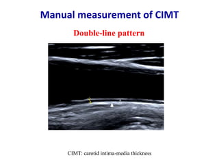 Carotid intima-media thickness | PPTX