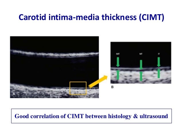 Carotid intima-media thickness