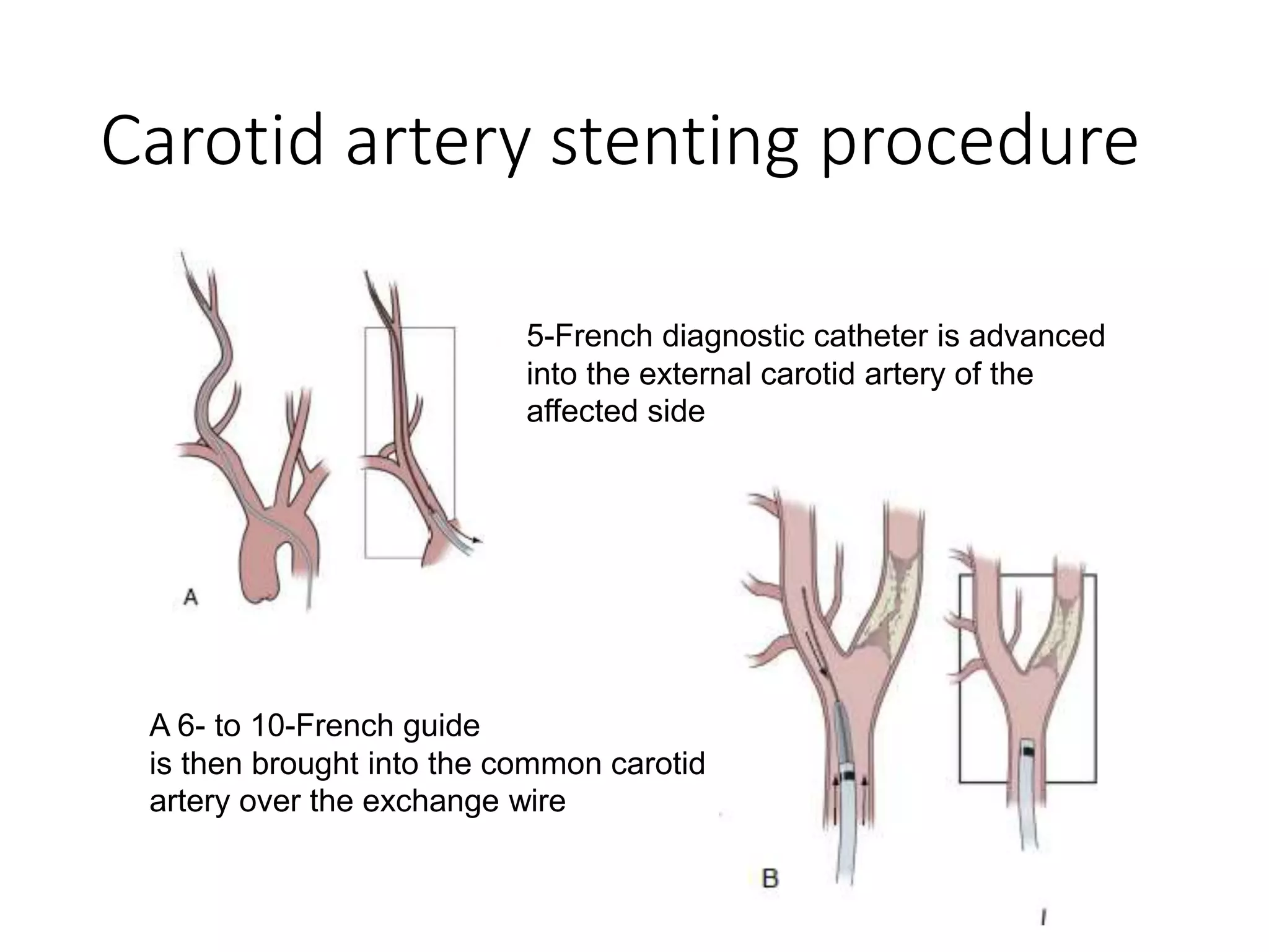 Carotid Occlusive Disease.pptx