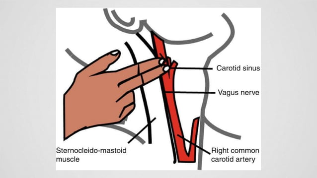CAROTID SINUS presentation__.ppt | Ear, Nose and Throat Conditions ...