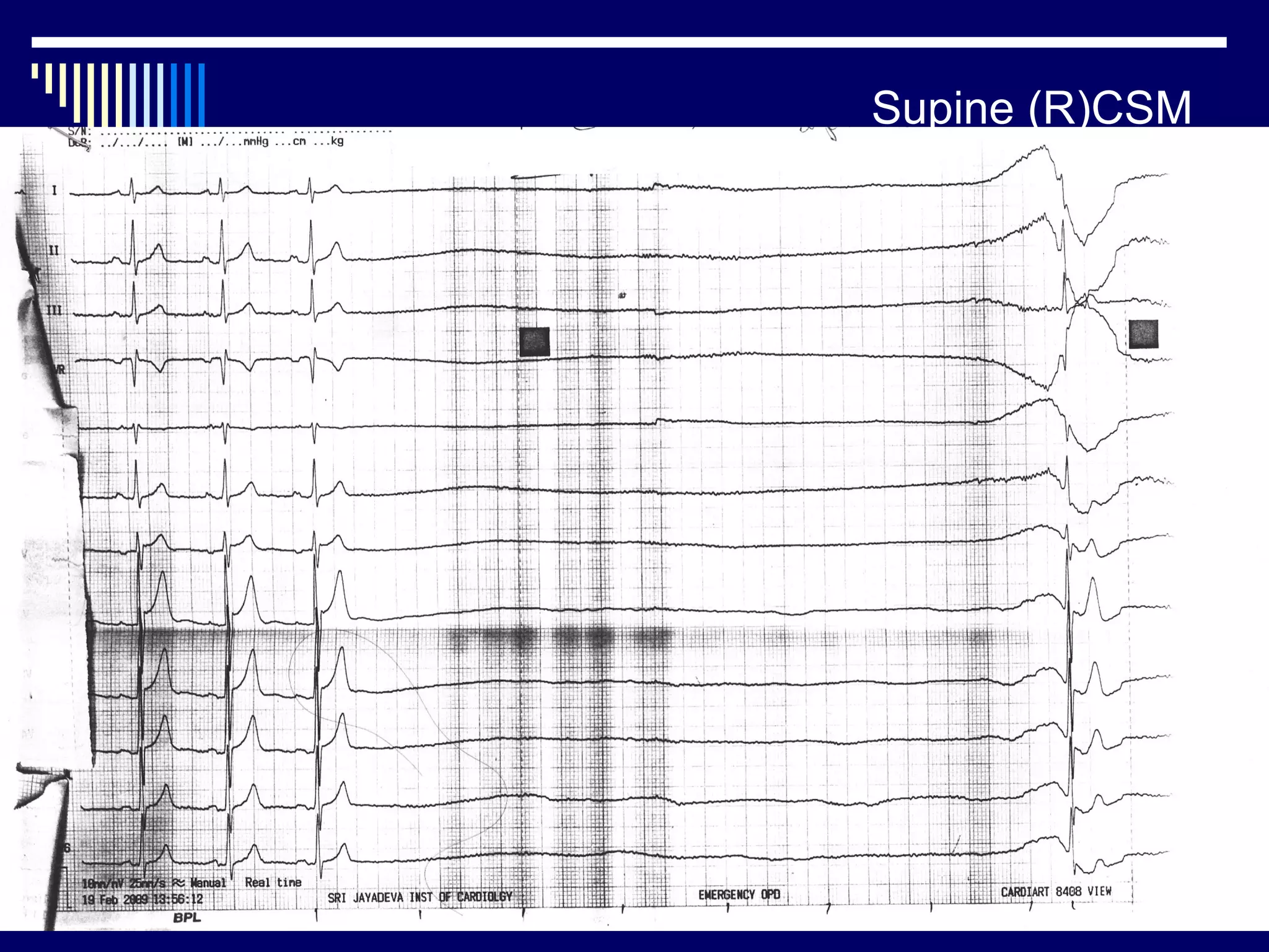Carotid sinus syncope | PPT