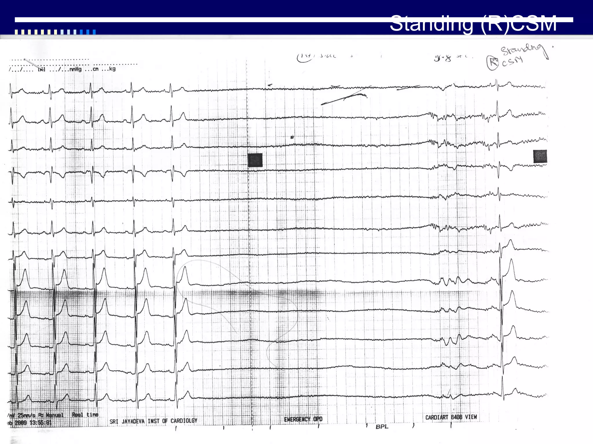 Carotid sinus syncope | PPT