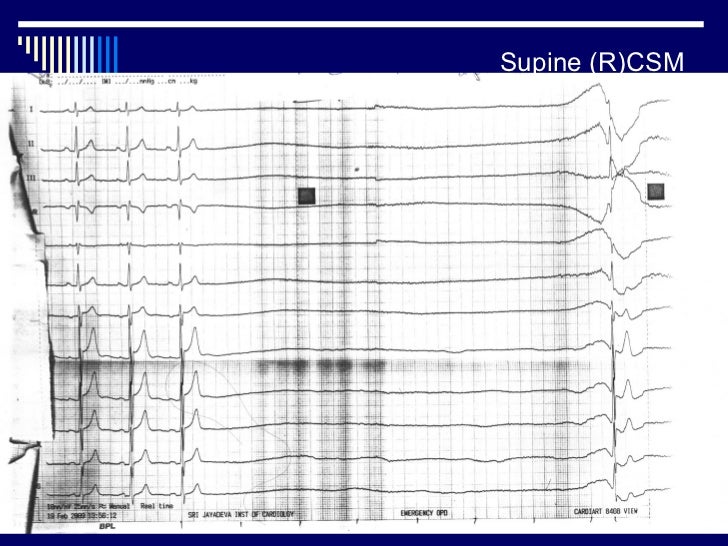 Carotid Sinus Syncope