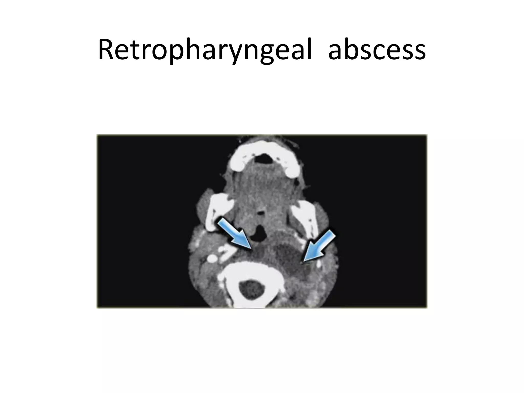 Carotid space tumour final.ppt