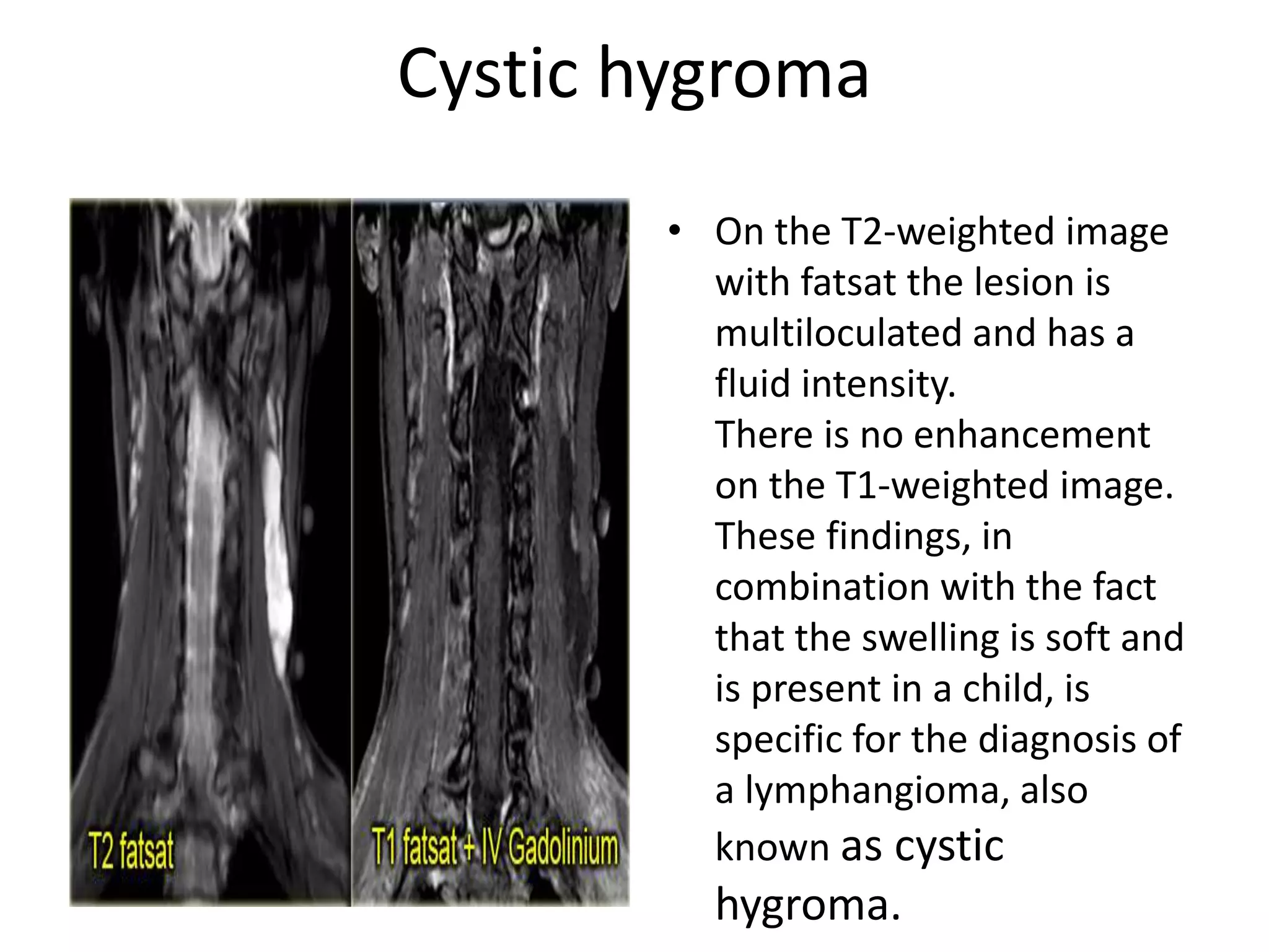 Carotid space tumour final.ppt