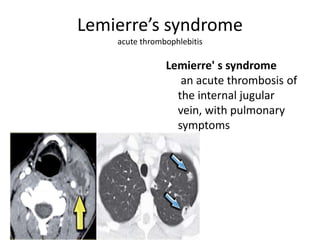 Carotid space tumour final.ppt