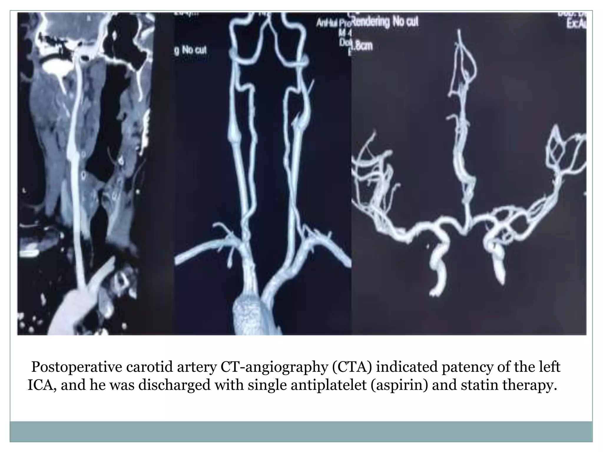 CAROTID WEB.pptx