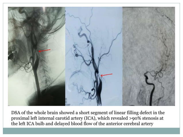 CAROTID WEB.pptx