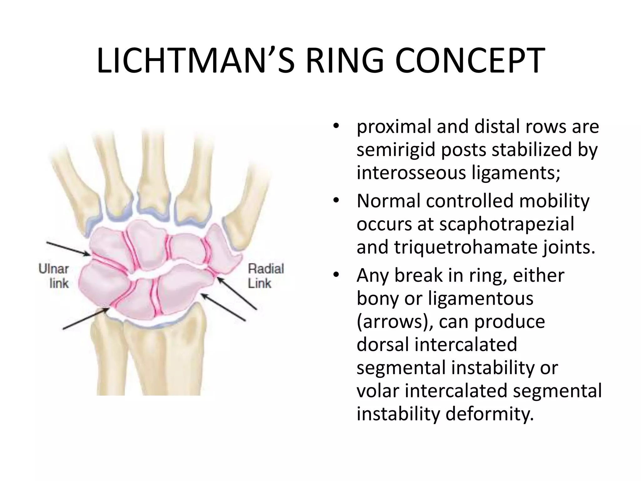 Carpal bone fractures | PPTX