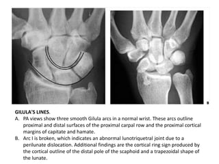 Carpal bone fractures | PPTX