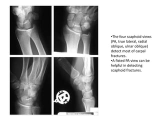 Carpal bone fractures | PPTX