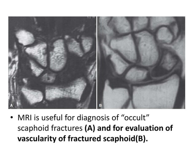 Carpal Bone Fractures