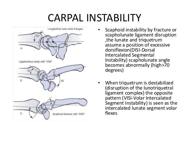 Carpal bone fractures