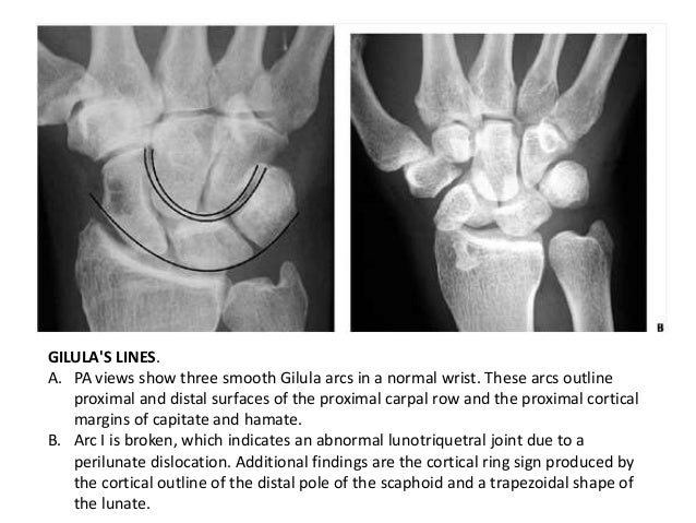 Carpal bone fractures