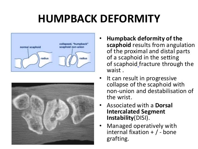 Carpal bone fractures