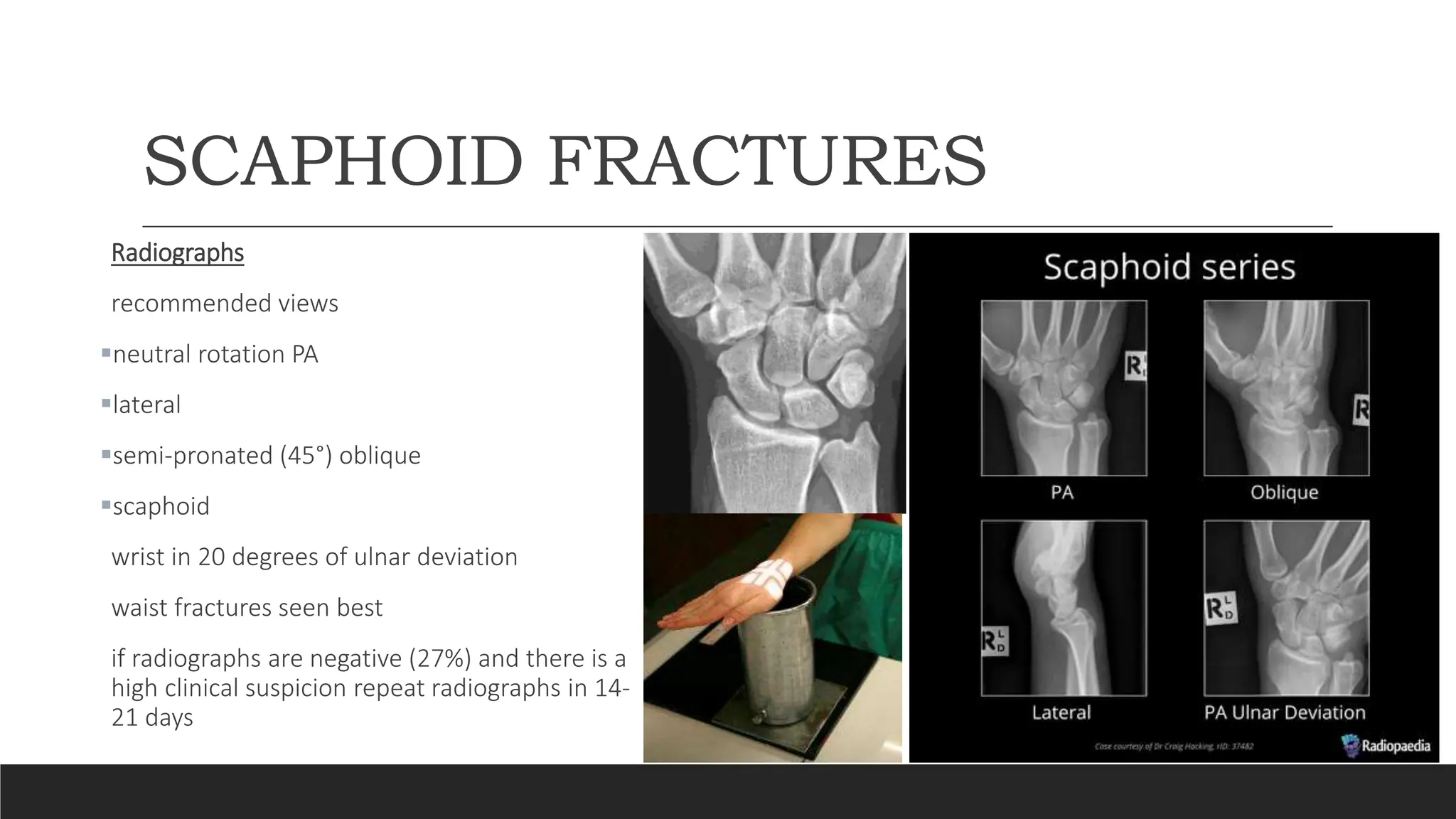 CARPAL BONES FRACTURES GENERALITES.pptx