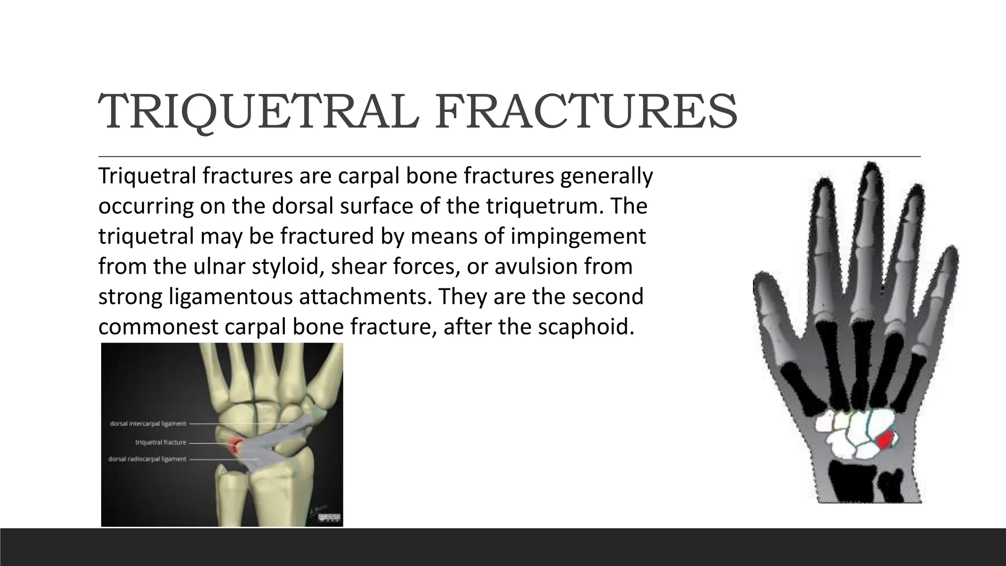 CARPAL BONES FRACTURES GENERALITES.pptx
