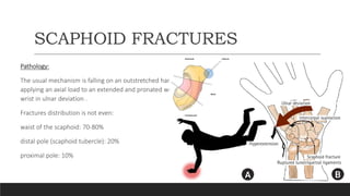 CARPAL BONES FRACTURES GENERALITES.pptx