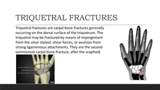 CARPAL BONES FRACTURES GENERALITES.pptx