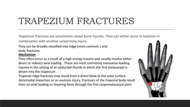 CARPAL BONES FRACTURES GENERALITES.pptx