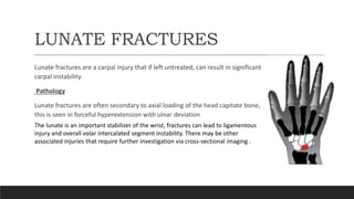 CARPAL BONES FRACTURES GENERALITES.pptx