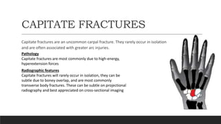 CARPAL BONES FRACTURES GENERALITES.pptx