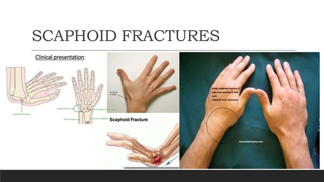 CARPAL BONES FRACTURES GENERALITES.pptx
