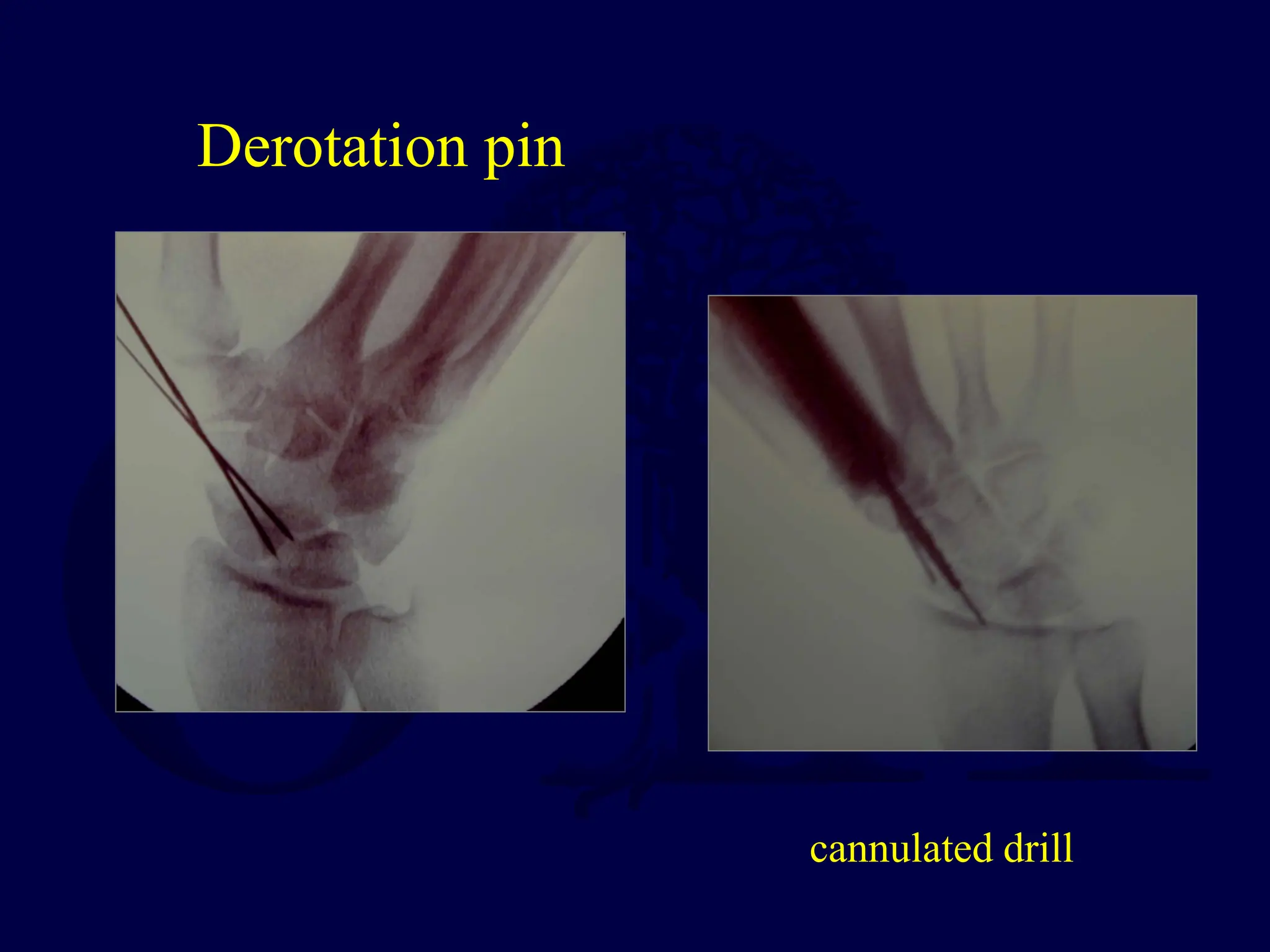 Carpal Fractures and Dislocations.....pdf