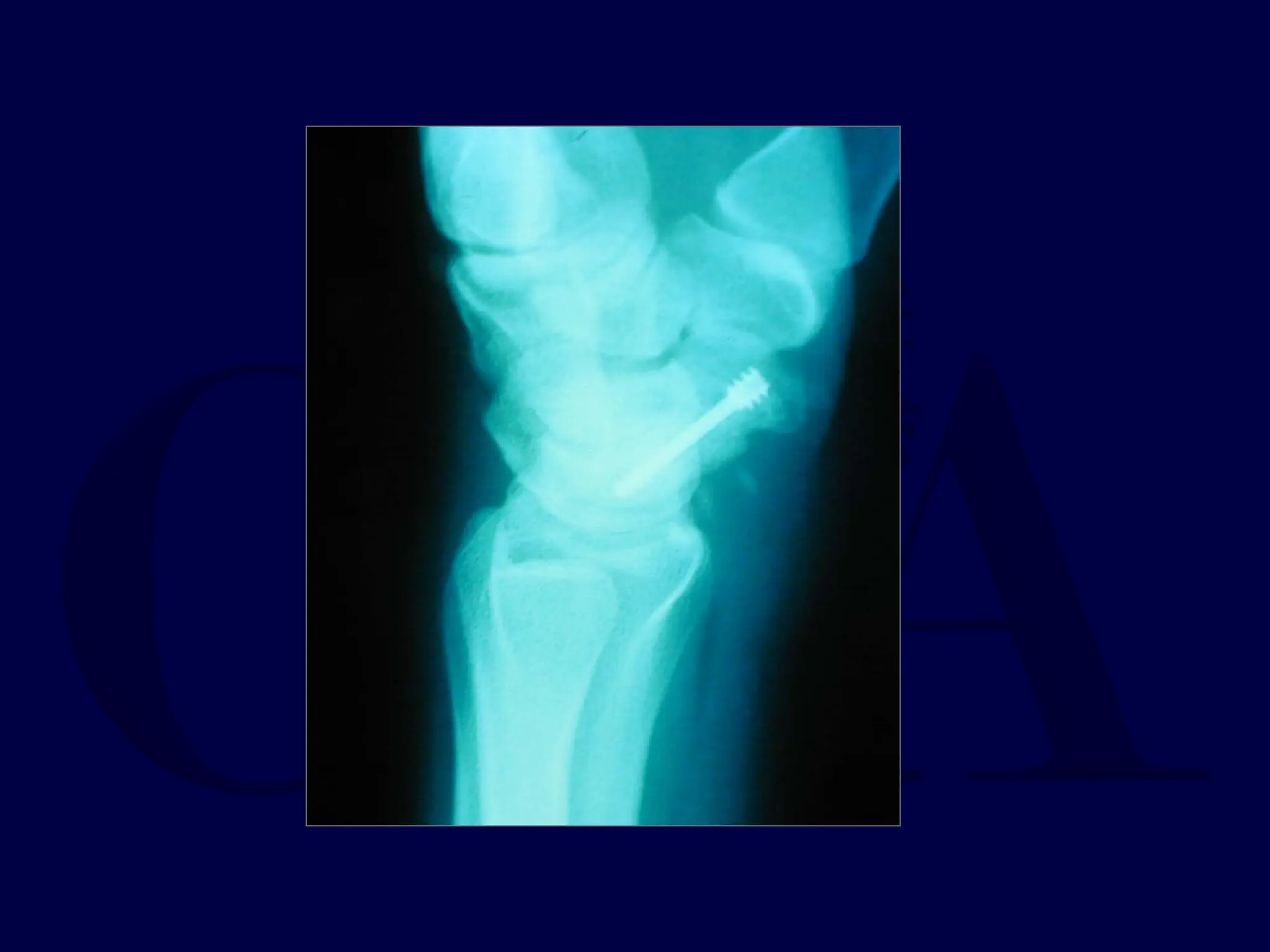 Carpal Fractures and Dislocations.....pdf