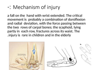 Carpal bones injuries نذير العزعزي.pptx