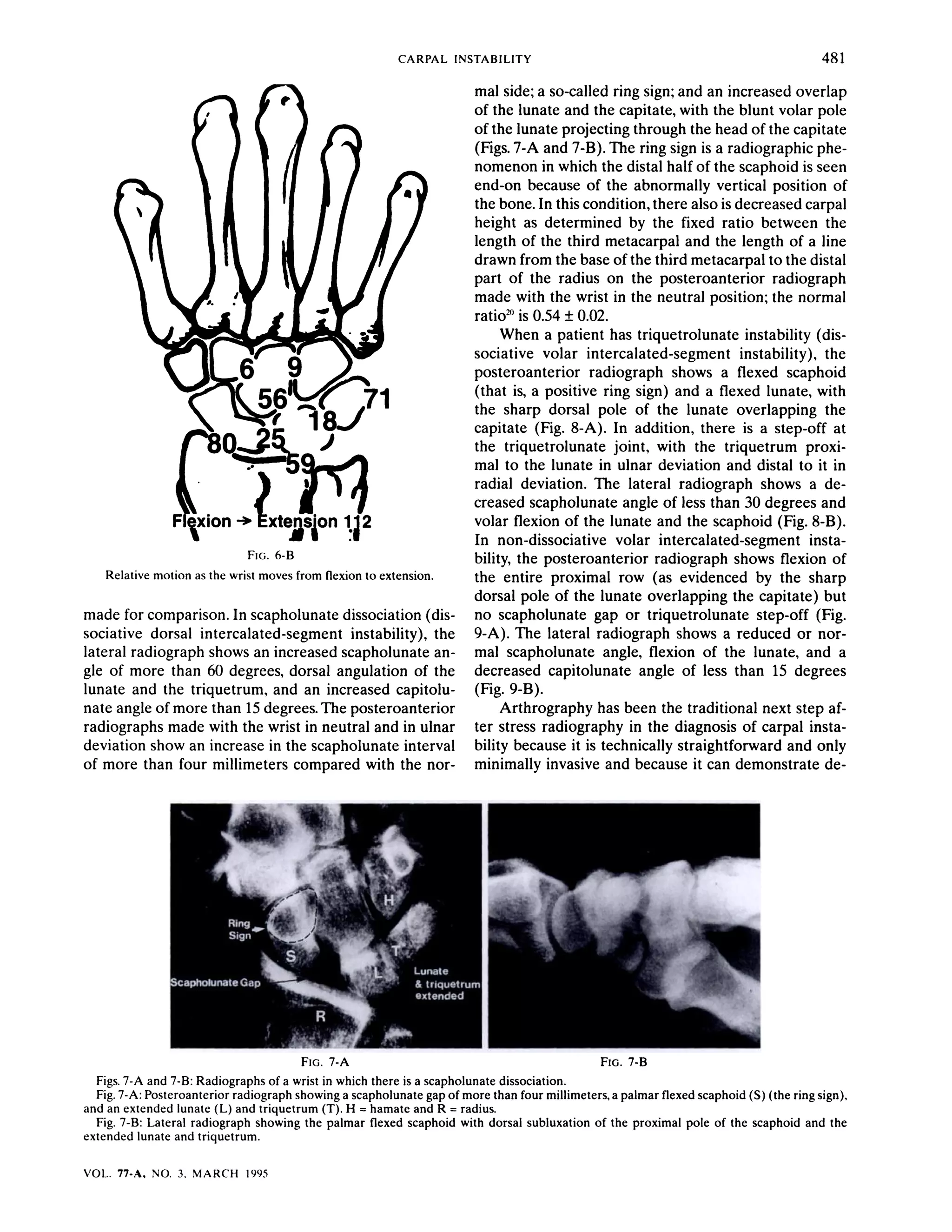 Carpal instability | PDF