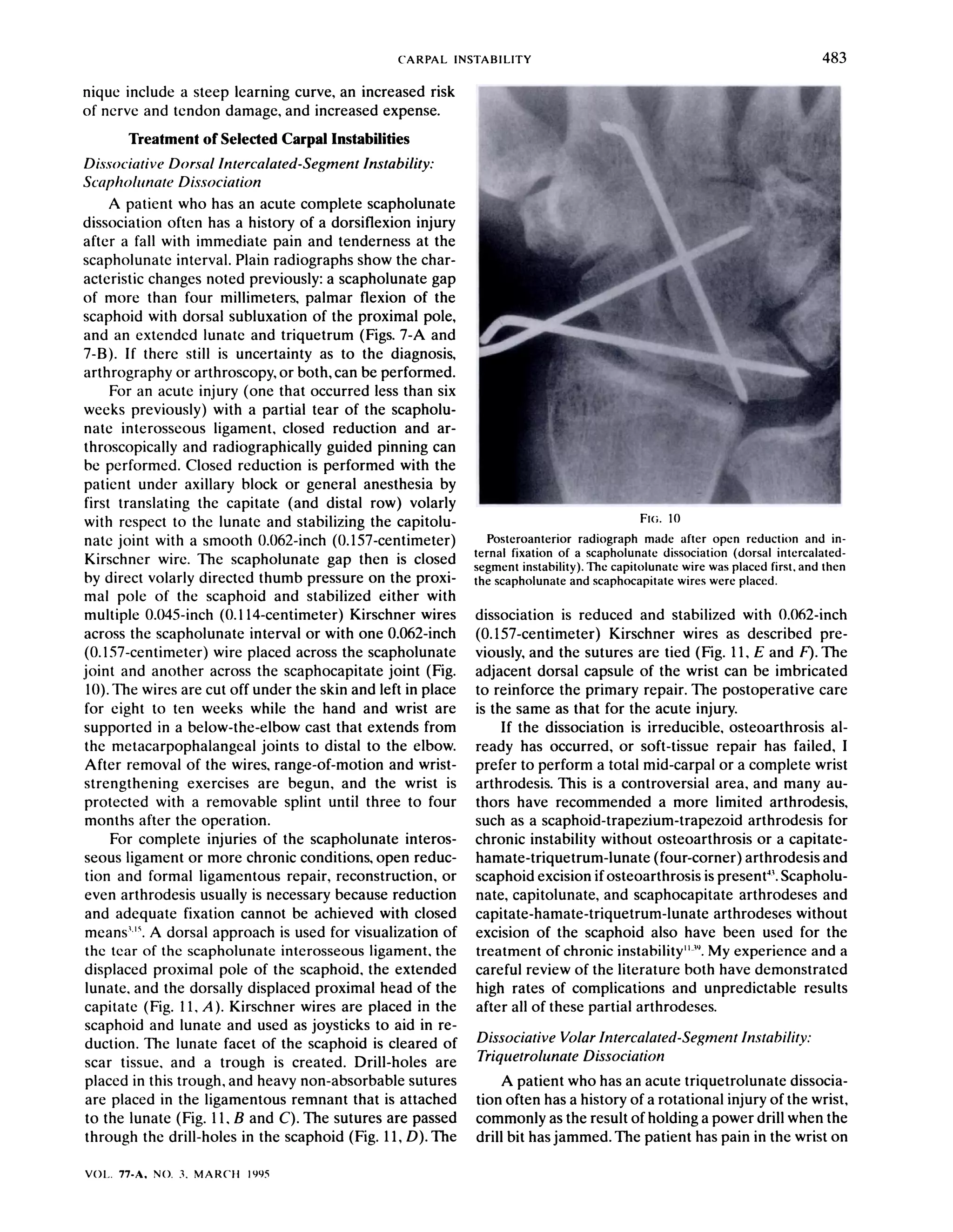 Carpal instability | PDF