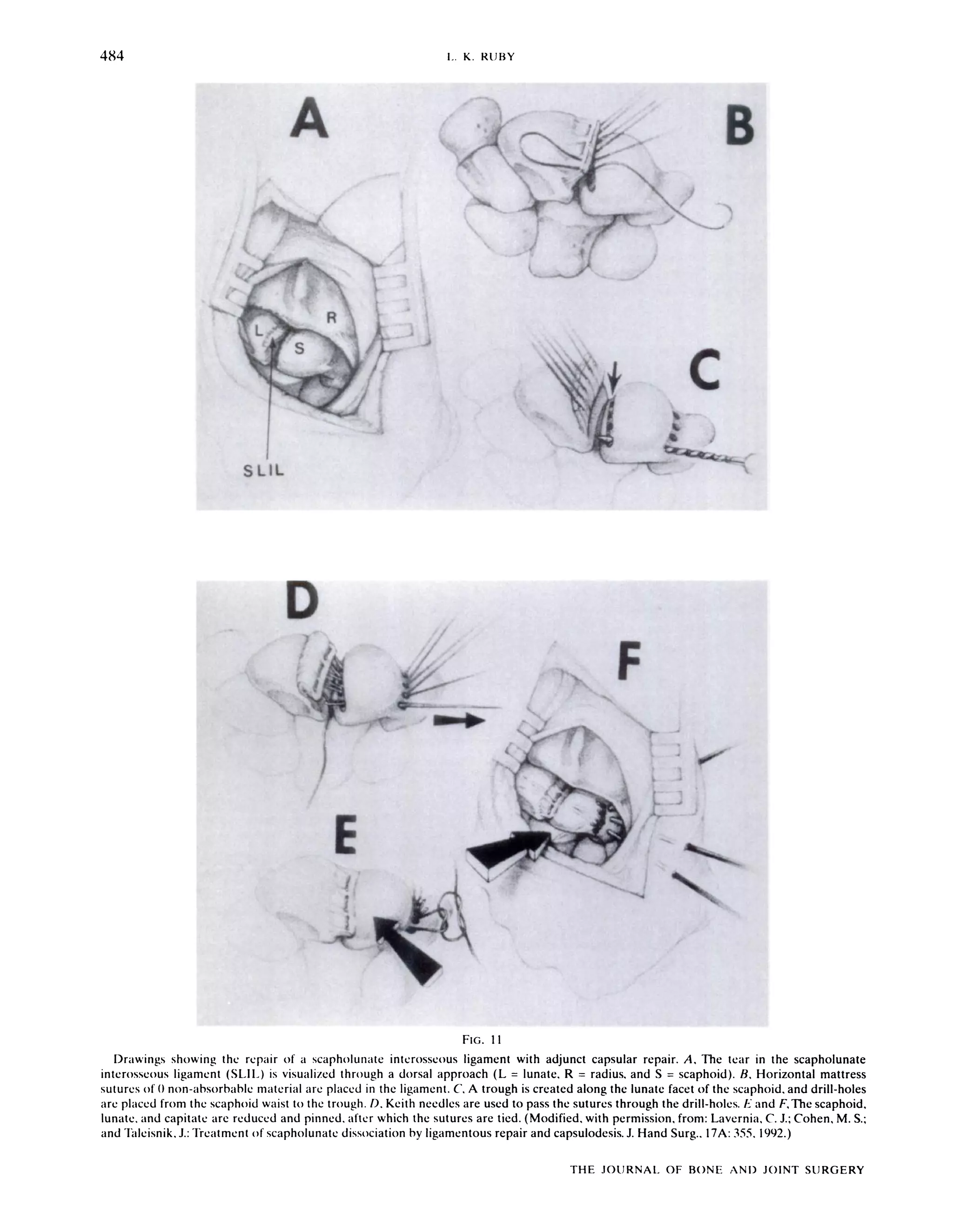 Carpal instability | PDF