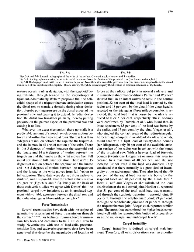 Carpal instability | PDF
