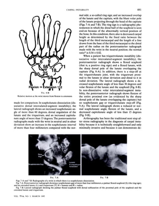 Carpal instability | PDF